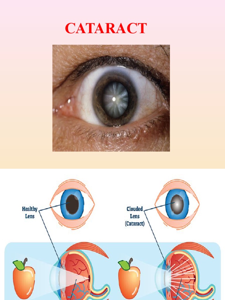 Cataract | PDF | Cataract | Vision