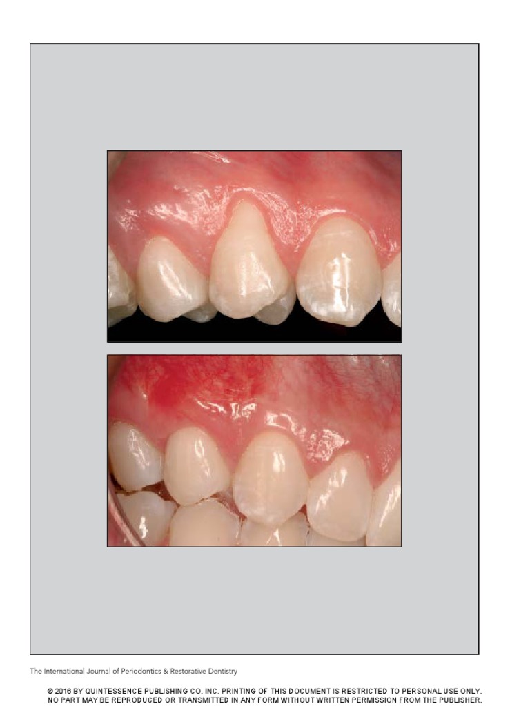 Clinical Considerations On The Root Coverage of Gingival Recessions in ...