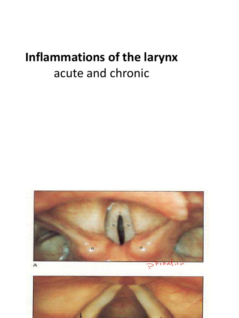 20 Inflammations of The Larynx | PDF | Respiratory Diseases ...