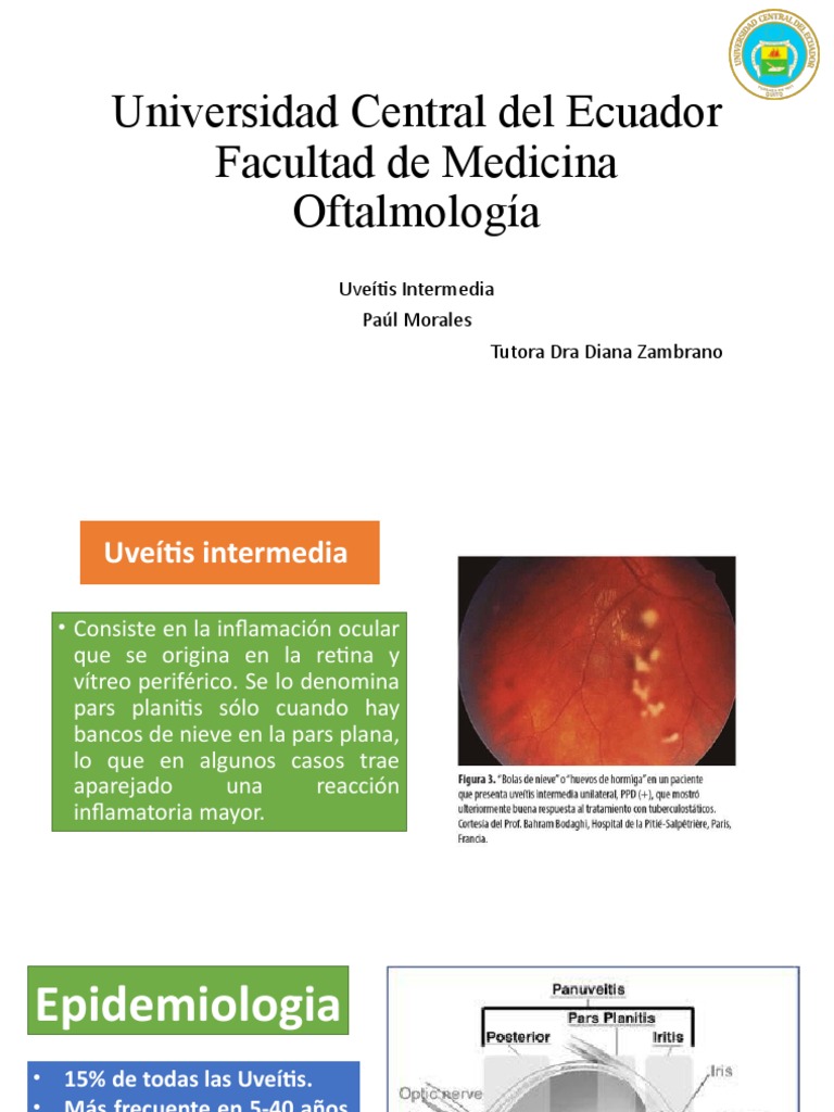 Uveítis Intermedia | PDF | Inflamación | Esclerosis múltiple