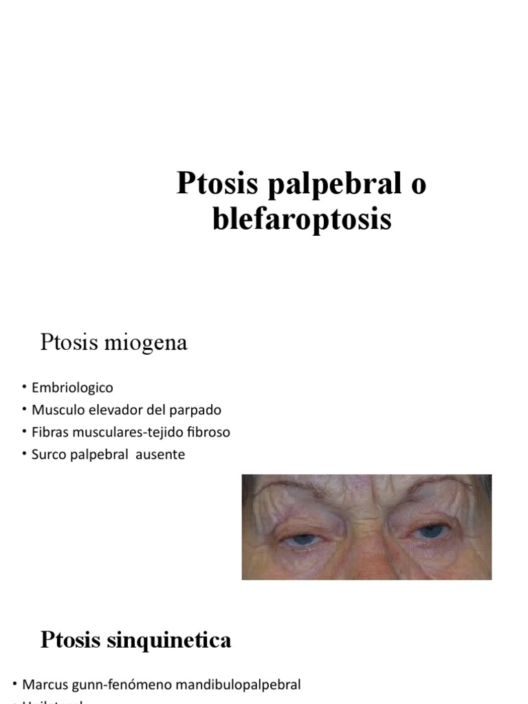 Ptosis Palpebral o Blefaroptosis | PDF | Ciencia y matemáticas