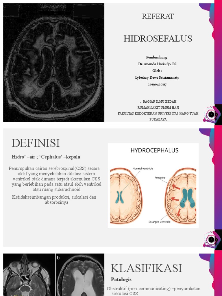 Hidrosefalus 1 | PDF