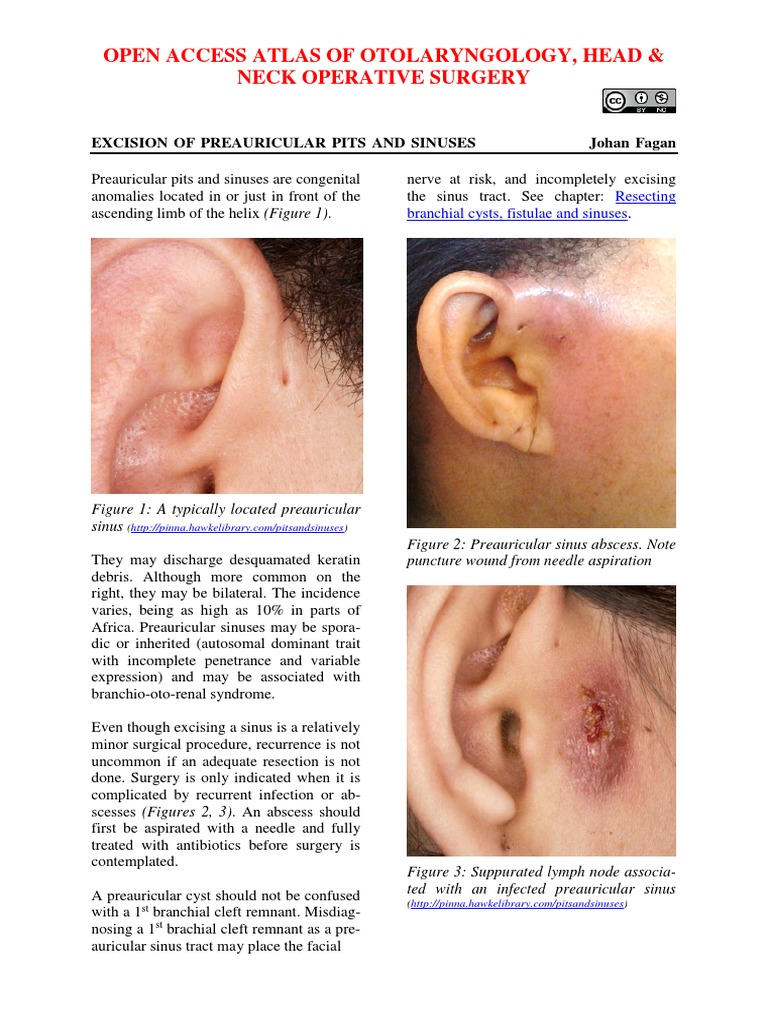 Excision of Preauricular Pits and Sinuses | PDF | Otorhinolaryngology ...