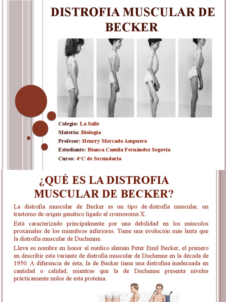 Distrofia Muscular de Becker | PDF | Enfermedades y trastornos ...