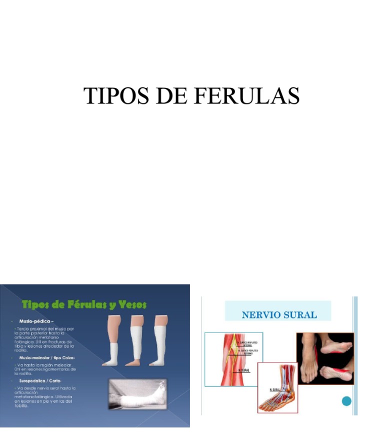 Tipos de Ferulas | PDF