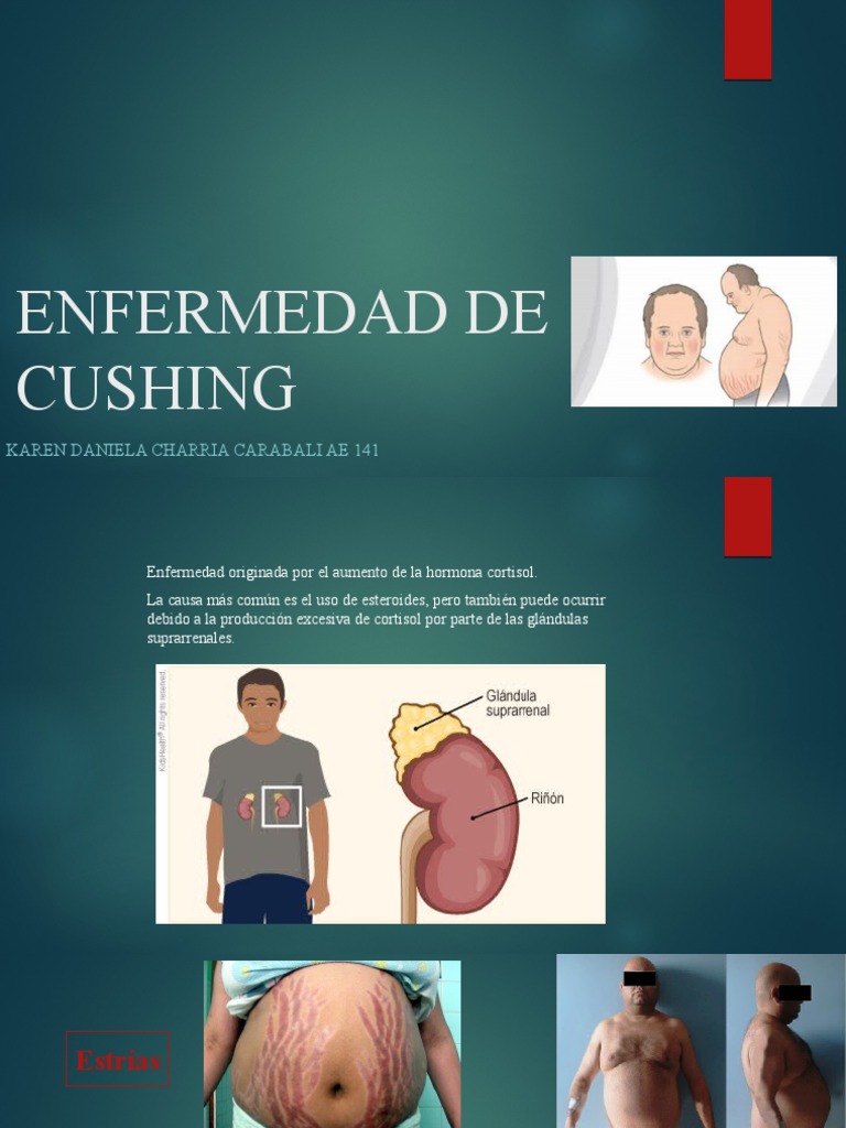 Enfermedad de Cushing | PDF