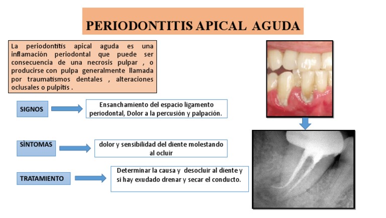 Periodontitis Apical Aguda | PDF