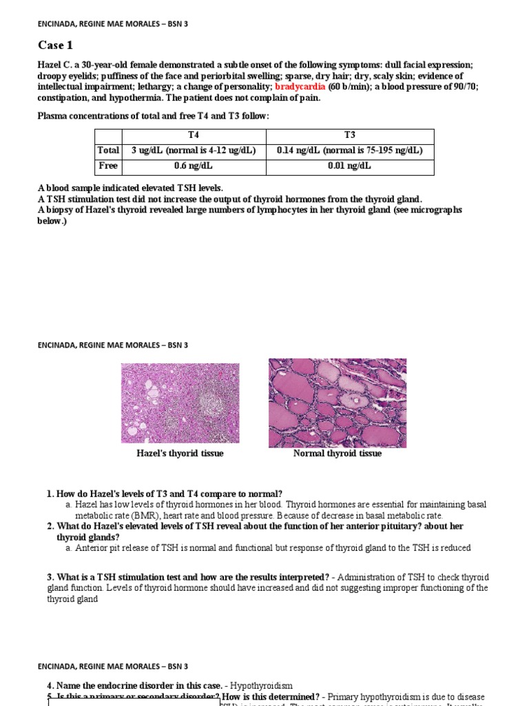 Hypothyroidism Case Study: Diagnosing and Treating Low Thyroid Hormone Levels in Patient Hazel C ...