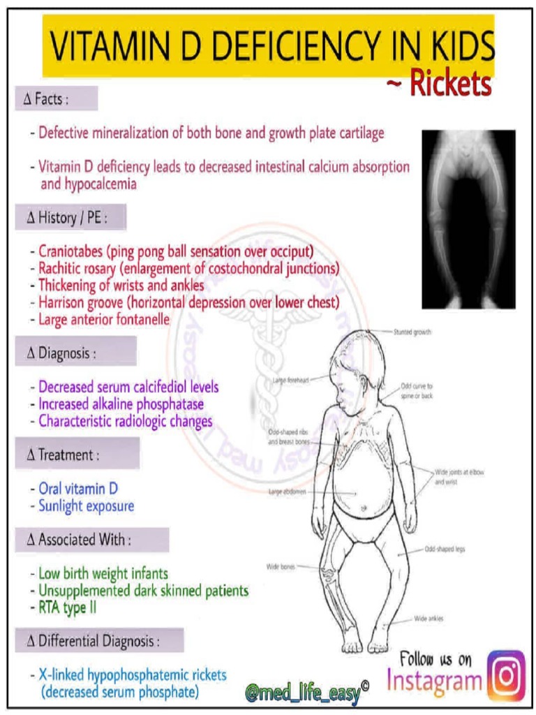 Vitamin D Deficiency in Kids (Rickets) | PDF