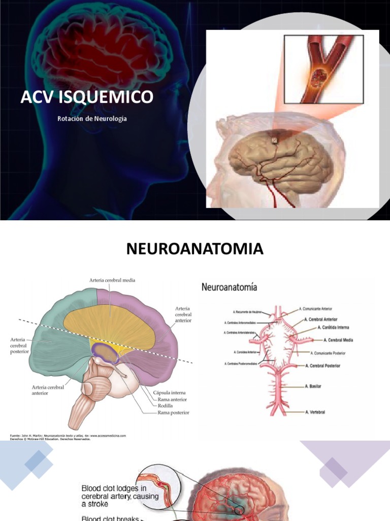 ACV Isquemico | PDF | Carrera | Isquemia