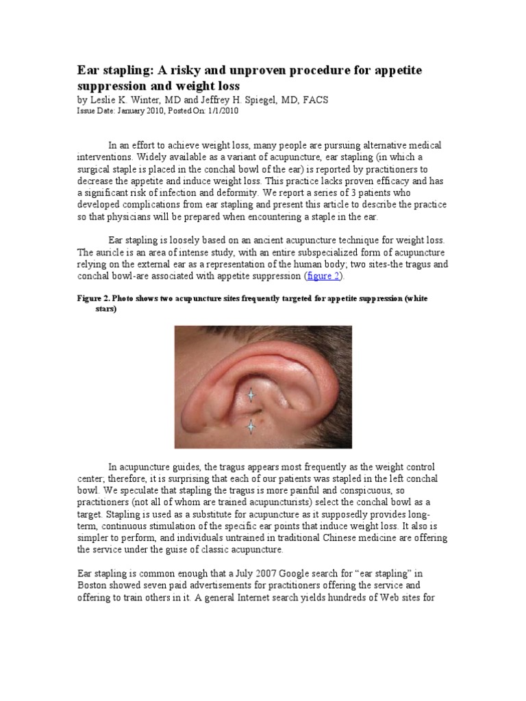 Ear Stapling | PDF | Acupuncture | Physician
