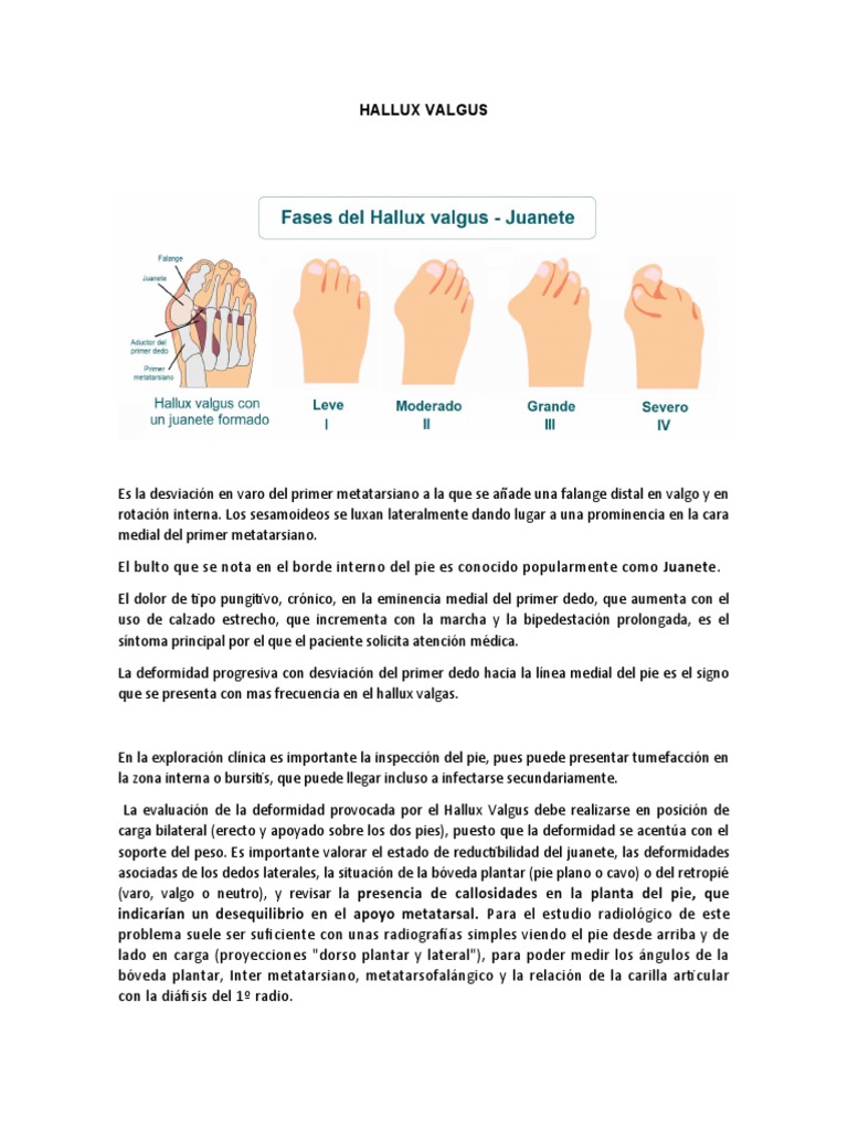 Hallux Valgus | PDF | Pie | Dedo del pie