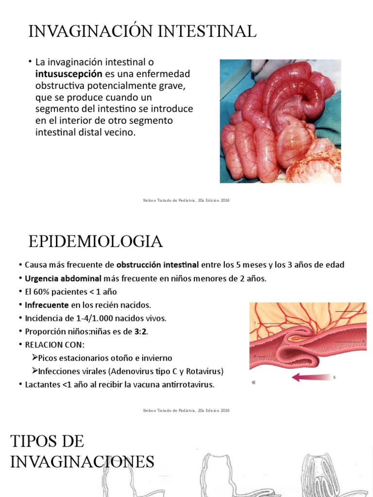 Invaginación Intestinal | PDF | Gastroenterología | Medicina CLINICA