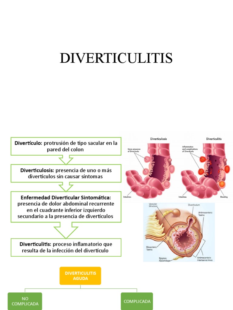 Diverticulitis: Síntomas y Complicaciones | PDF