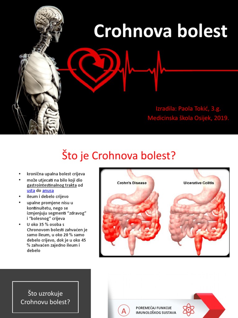 Kronova Bolest | PDF