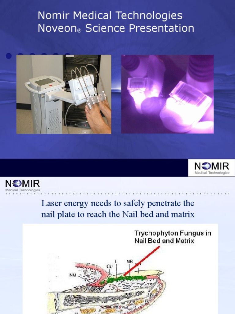 Noveon Laser Comparison | PDF | Nail (Anatomy) | Laser