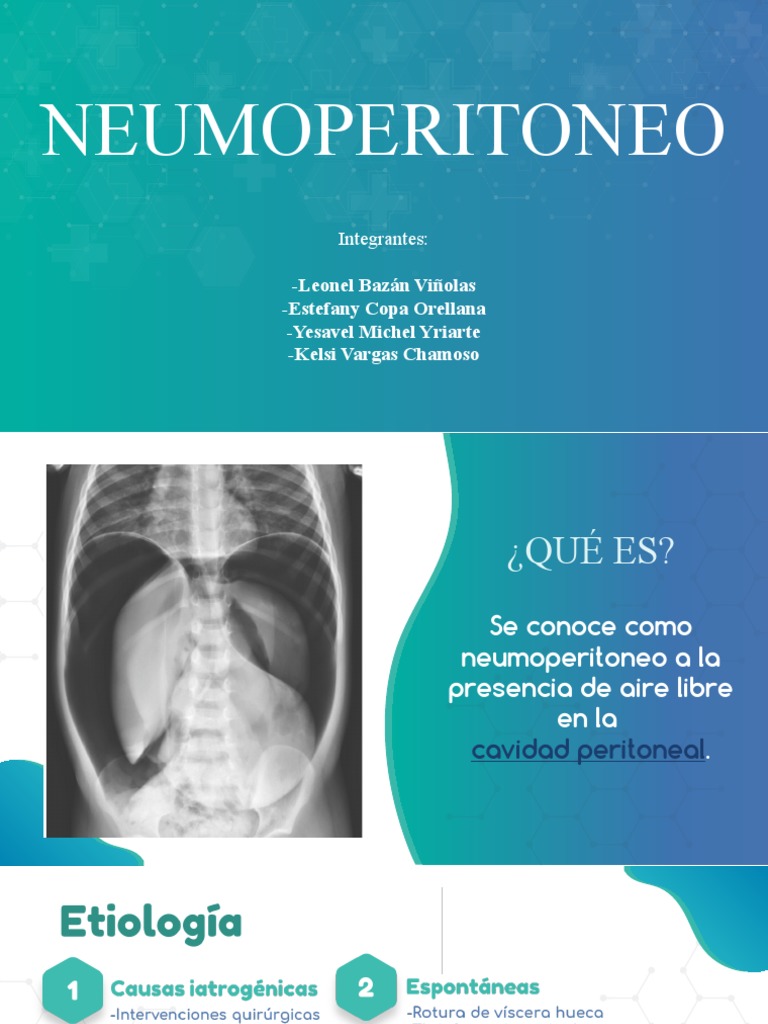 Signos Radiológicos del Neumoperitoneo | PDF | Abdomen | Peritoneo
