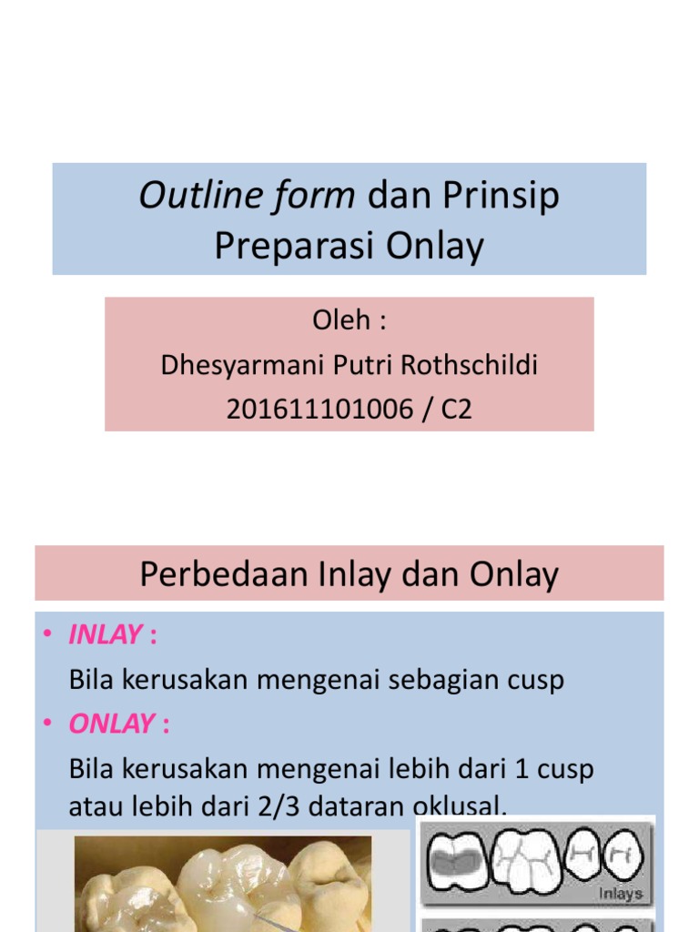 Outline Form Dan Prinsip Preparasi Onlay | PDF
