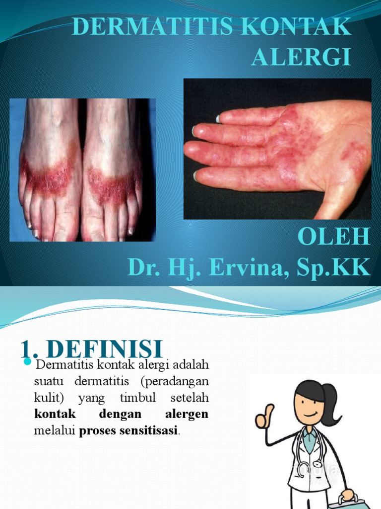 4. Dermatitis Kontak Alergi