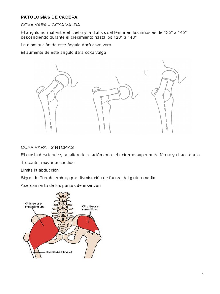 Patologías de la cadera: Coxa vara, coxa valga, epifisiólisis del fémur ...