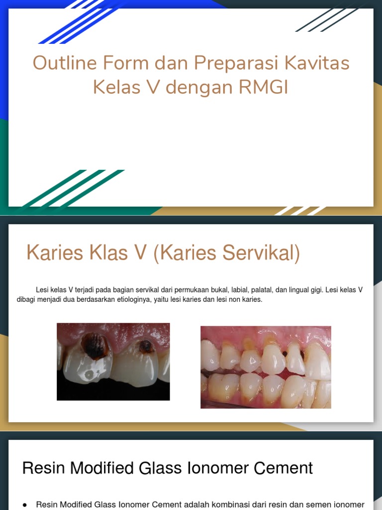 Outline Form Dan Preparasi Kavitas Kelas V Dengan RMGI | PDF