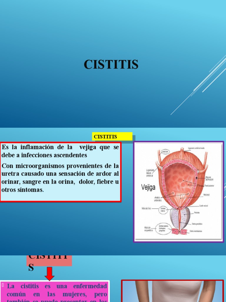 Cictitis Diapositivas | PDF | Infección del tracto urinario | Urología