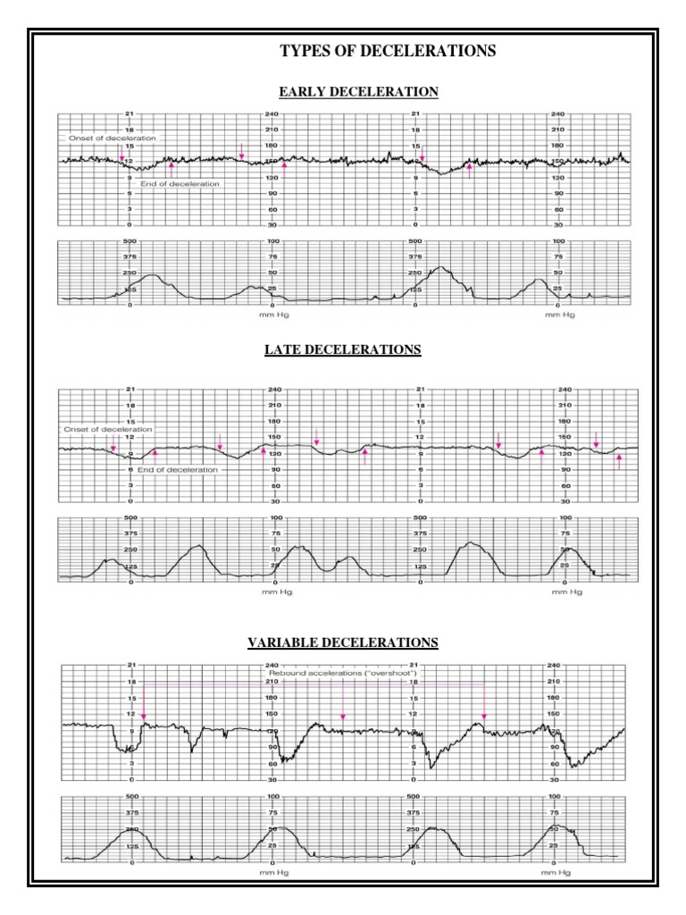 Types of Decelerations: Early Deceleration | PDF