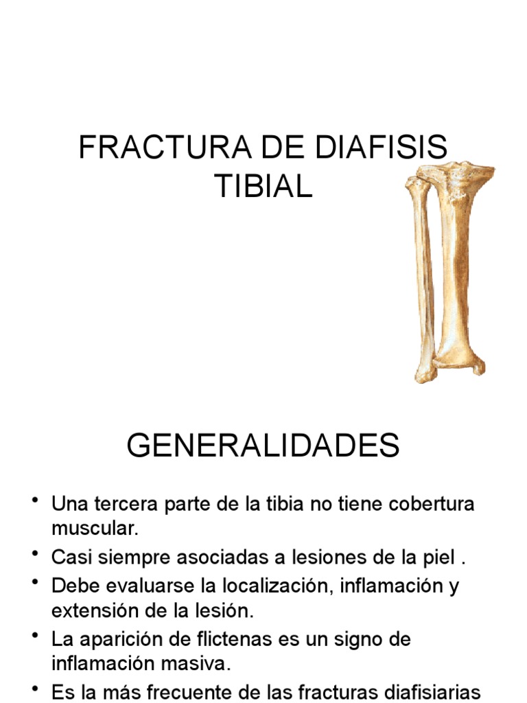 Fractura de Diafisis Tibial | PDF | Rodilla | Medicina