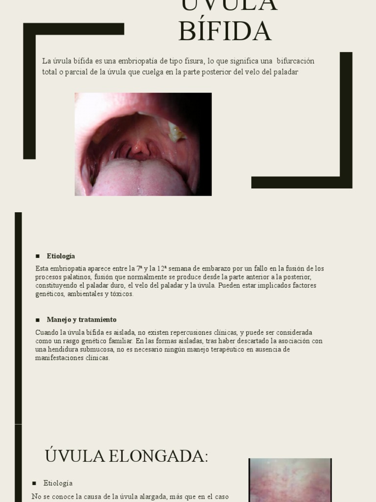 Tipos y consecuencias de la úvula bífida | PDF