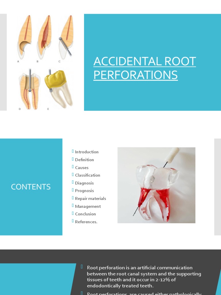 Accidental Root Perforations | PDF | Periodontology | Human Tooth