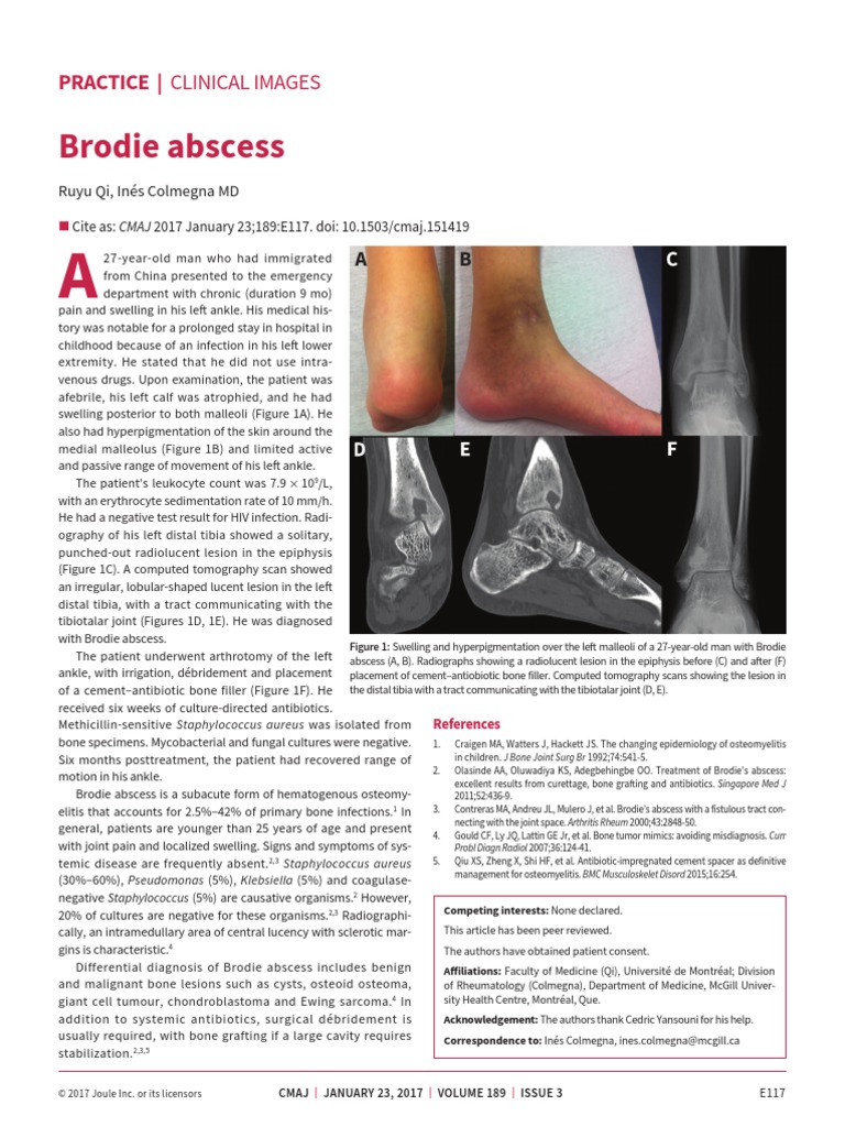 Brodie Abscess: Practice - Clinical Images | PDF | Ankle | Health Sciences