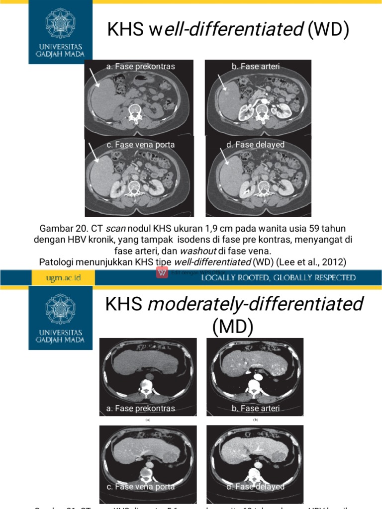 CT Scan KHS Sesuai Derajat Histopatologis | PDF