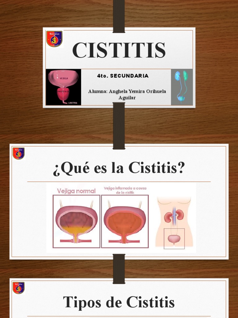 CISTITIS | PDF