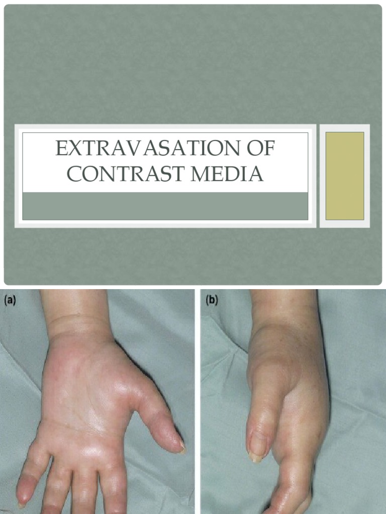 Mild Extravasation of Contrast Media | PDF | Intravenous Therapy | Vein
