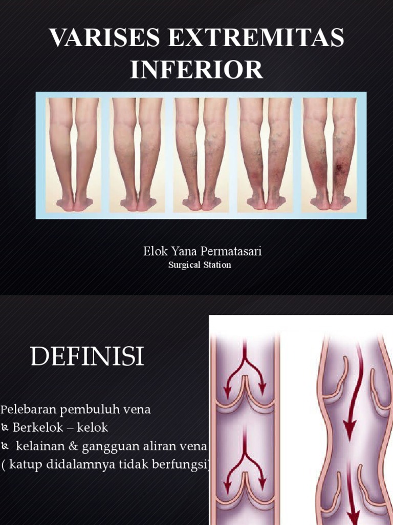 Varises Ekstremitas Inferior Elok Yana | PDF
