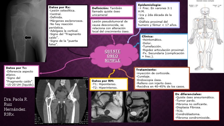 Quiste Oseo Simple | PDF | Sistema esquelético | Enfermedades y trastornos