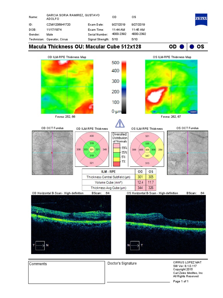 OS OD Macula Thickness OU: Macular Cube 512x128 | PDF