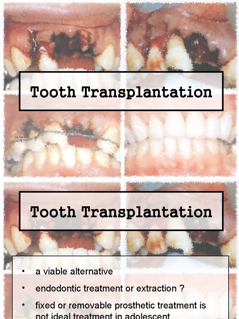 Tooth Transplantation | PDF | Tooth | Periodontology