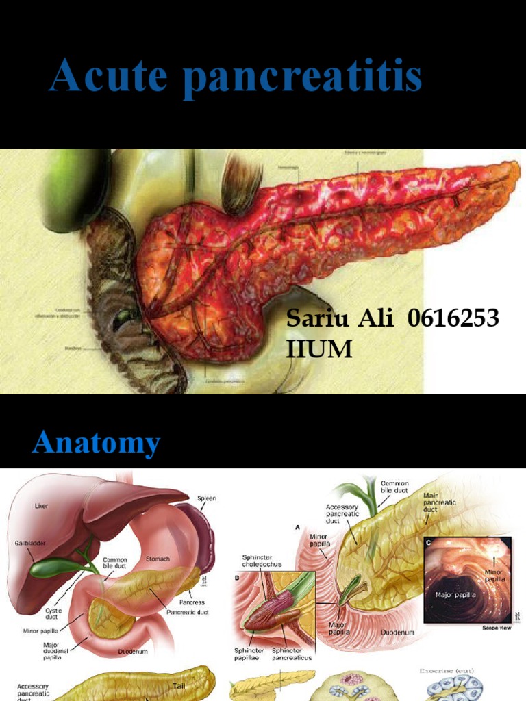 Understanding Acute Pancreatitis Causes | PDF | Pancreas | Digestive System