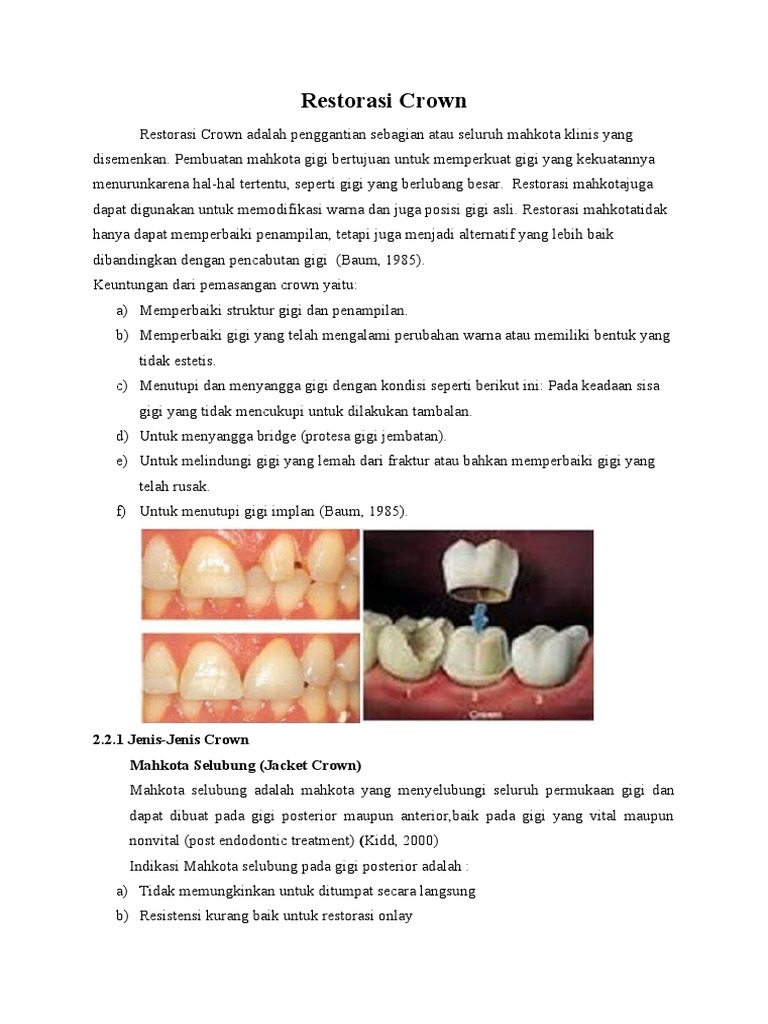 Dokumen - Tips Restorasi Crown | PDF