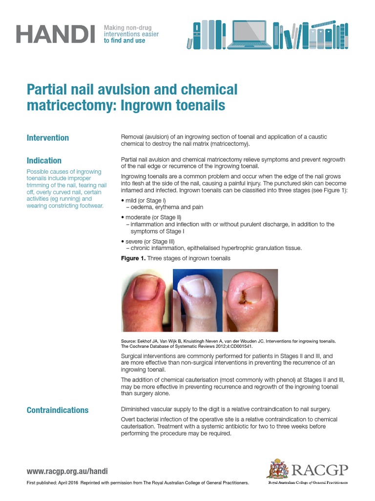 Partial Nail Avulsion and Matricectomy For Ingrown Toenails | PDF ...