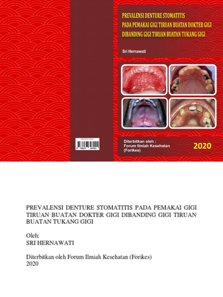 DENTURE STOMATITIS - Sri Hernawati Stomatitis PDF | PDF