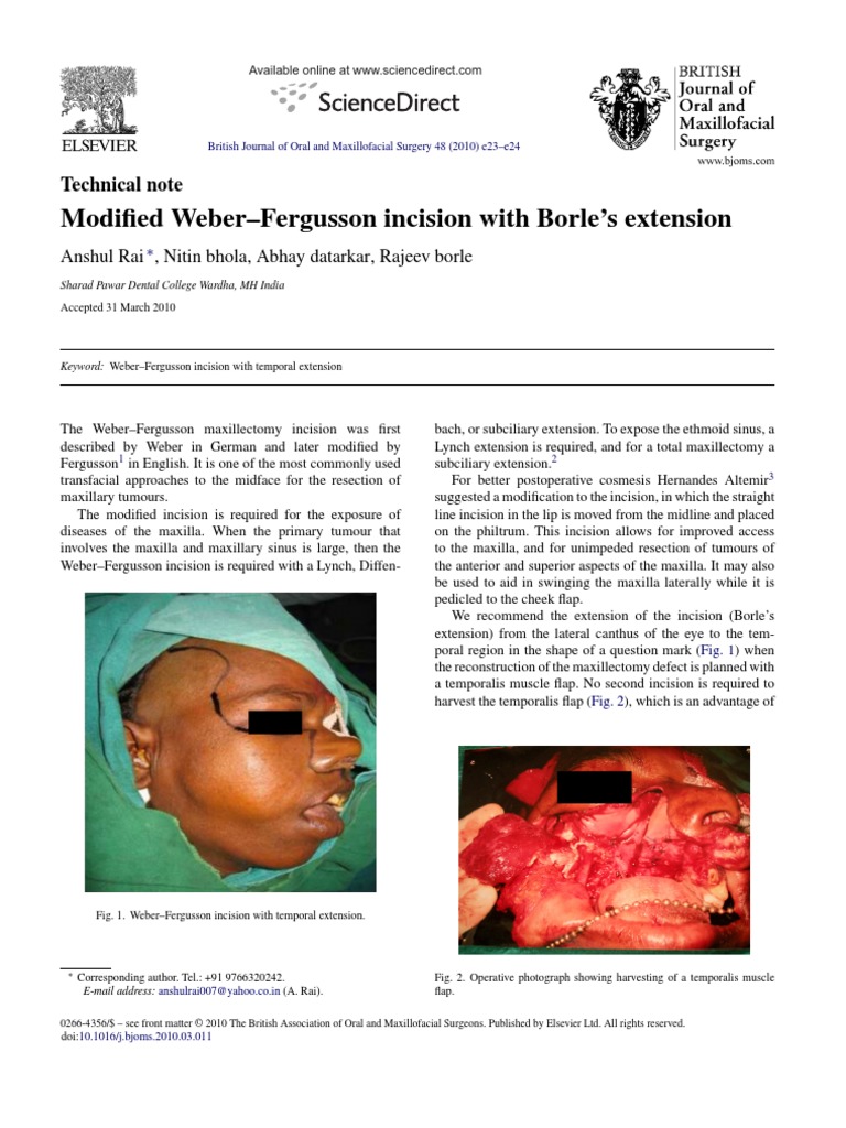 Modified Weber-Fergusson Incision With Borle's Extension: Technical ...