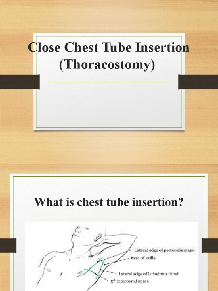 Close Chest Tube Insertion Thoracostomy | PDF | Thorax | Lung
