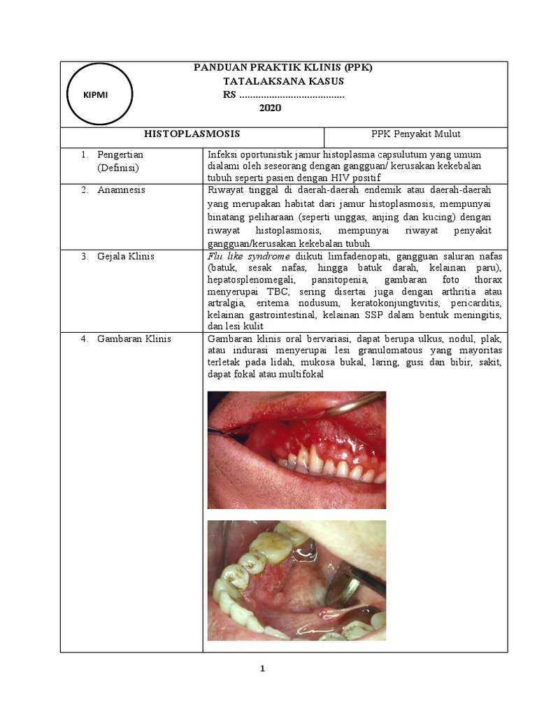 Draft PPK Kel 1 hISTOPLASMOSIS | PDF