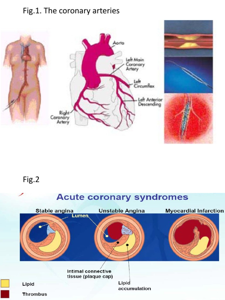 Classification of Angina Severity and Diagnosis of Ischemic Cardiopathy ...