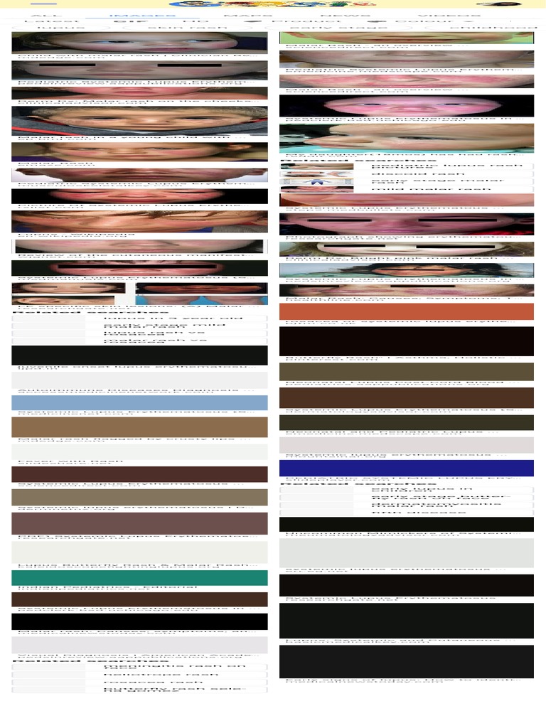 Malar Rash Pediatrics - Google Search | PDF | Systemic Lupus ...