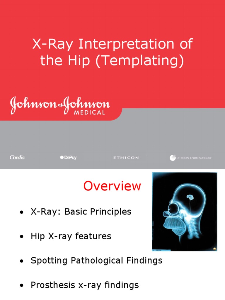 Hip X-Ray Interpretation and Templating | PDF | Hip | Pelvis