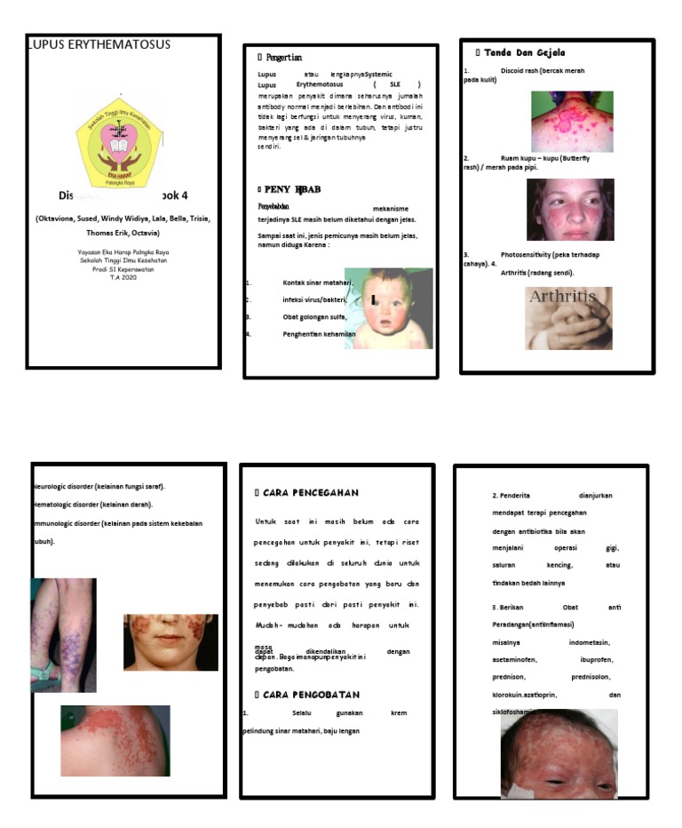 Kelompok 4 (Leaflet Lupus) | PDF