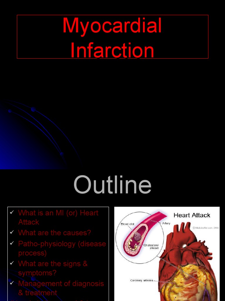 Myocardial Infarction | PDF | Myocardial Infarction | Heart